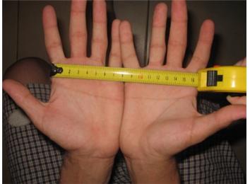 Longest Single Transverse Palmar Crease Across Two Hands | World Record ...