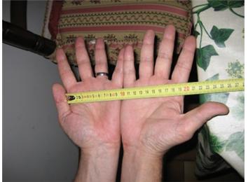 Longest Single Transverse Palmar Crease Across Two Hands | World Record ...